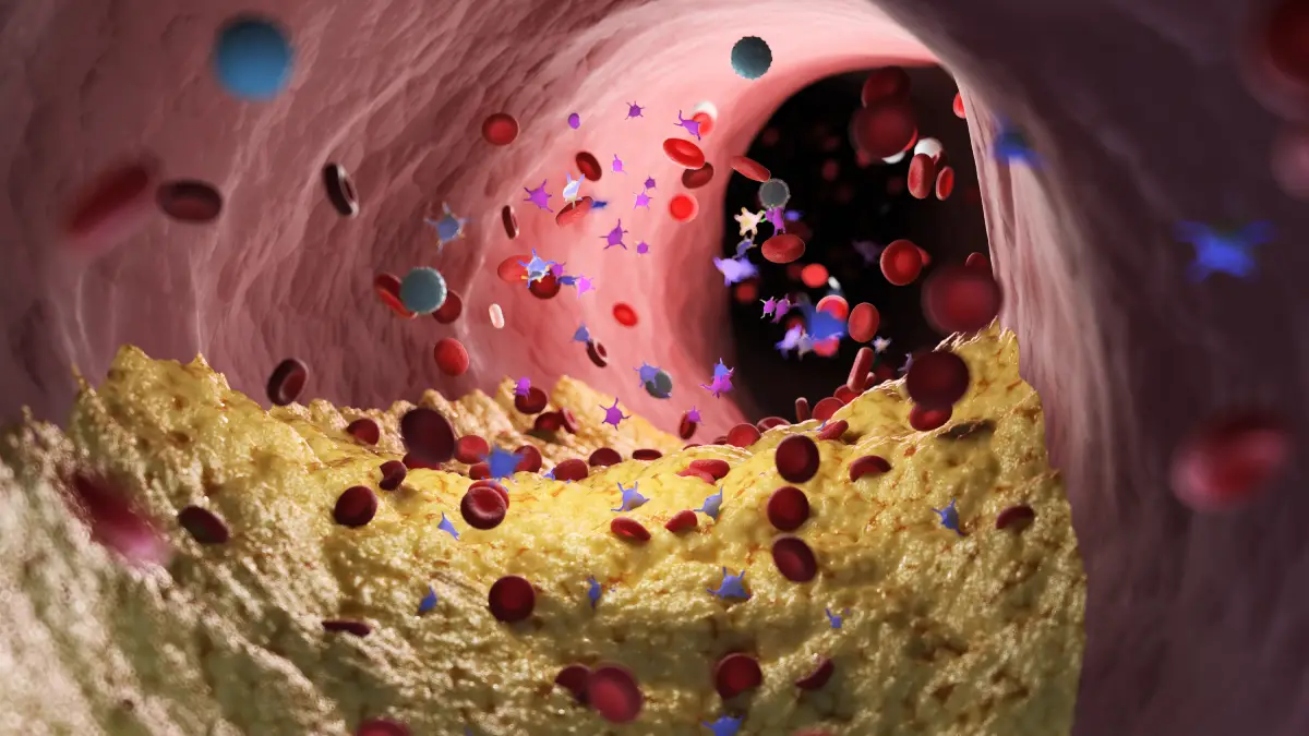 Endocrinologia: Hipertrigliceridemia: fisiopatologia, sintomas e tratamento