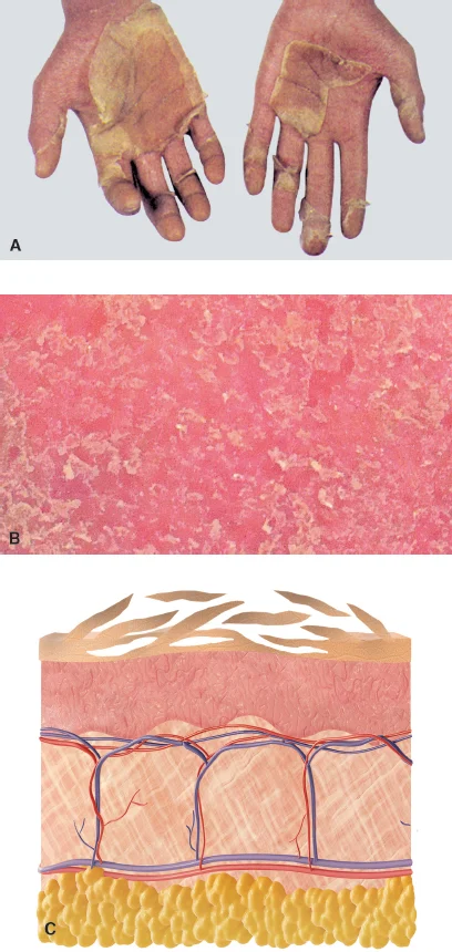 Dermatologia: Classificação das lesões elementares da pele
