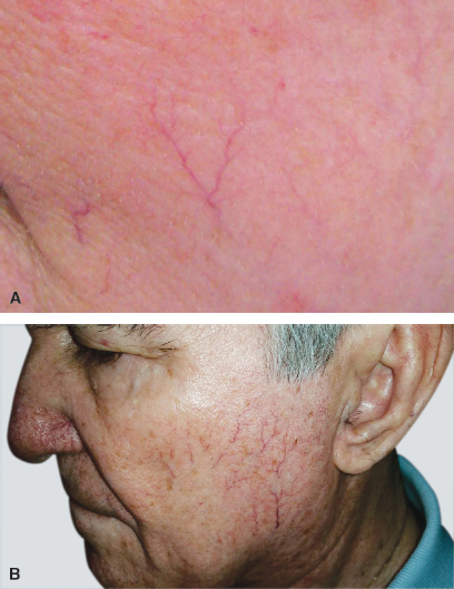 Dermatologia: Classificação das lesões elementares da pele