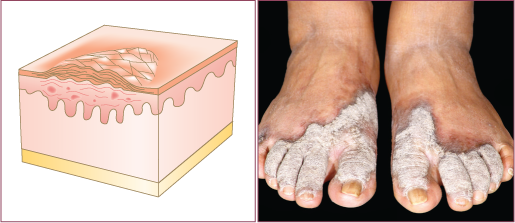 Dermatologia: Classificação das lesões elementares da pele