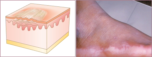 Dermatologia: Classificação das lesões elementares da pele