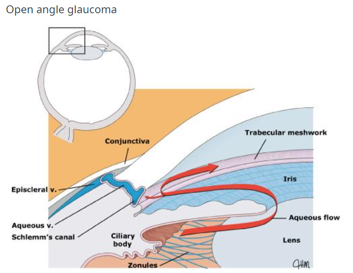 Clínica Médica: Glaucoma: o que é, causa, sintomas e tratamento