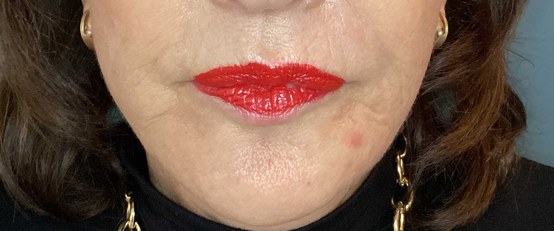 Botuline Toxine en Fillers bij Beauty Centre Maastricht