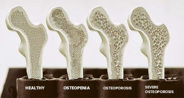 How to Spot the Symptoms of Osteoporosis Early