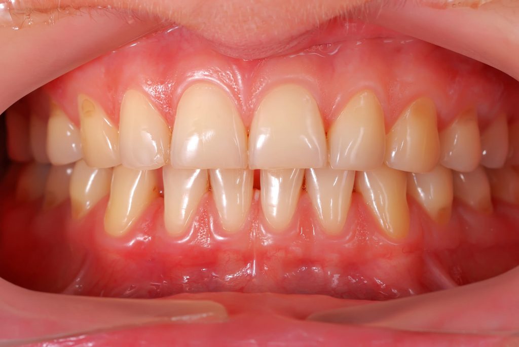 Different Teeth Colors and What It Means - Midtown Dental Studio