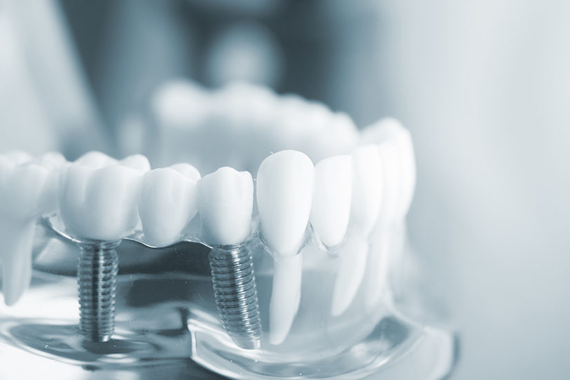Dental Implant & Tooth Implant Manchester | Smart Dental Care