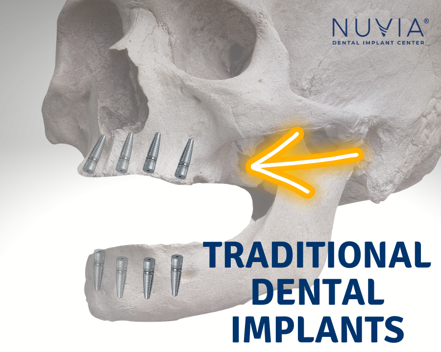 Navigating Bone Loss: The Advantages of Zygomatic Dental Implants