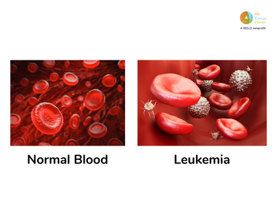 What is Leukemia? Learn About Leukaemia on MyCancerHaven Blog