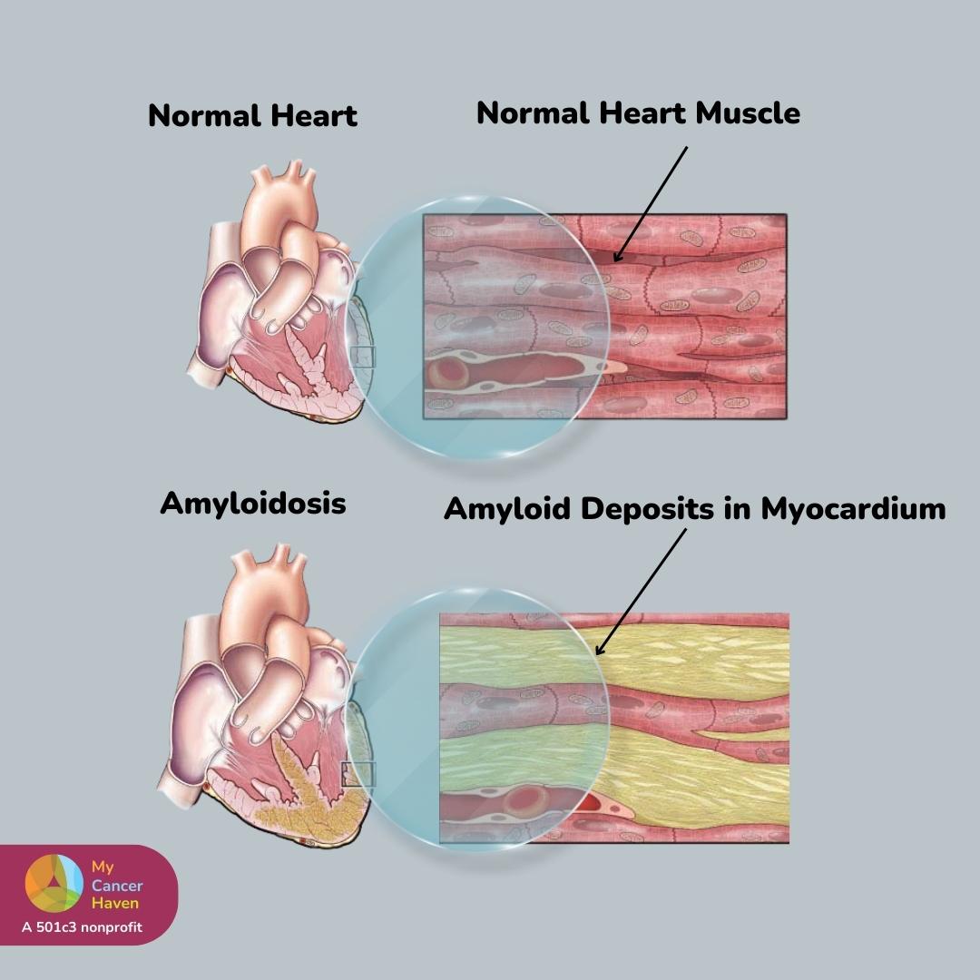 Understanding AL Amyloidosis - Effects, Causes & Prevention