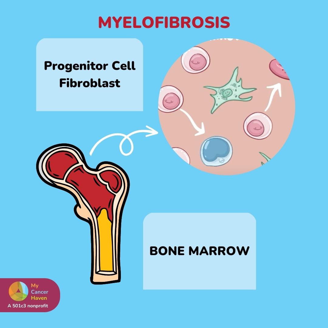 Understanding Myelofibrosis| MCH Blog