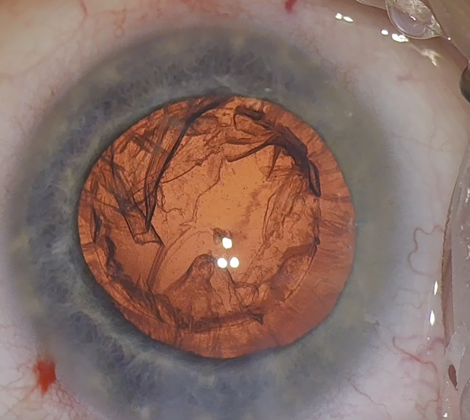 Cataract surgery steps