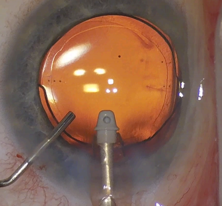 Cataract surgery steps