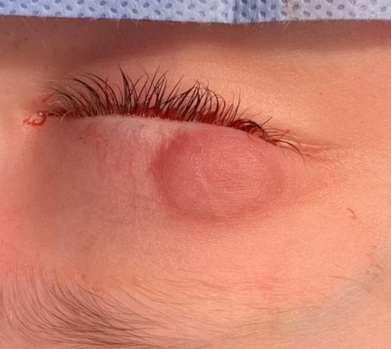 Incision and Drainage of a Chalazion