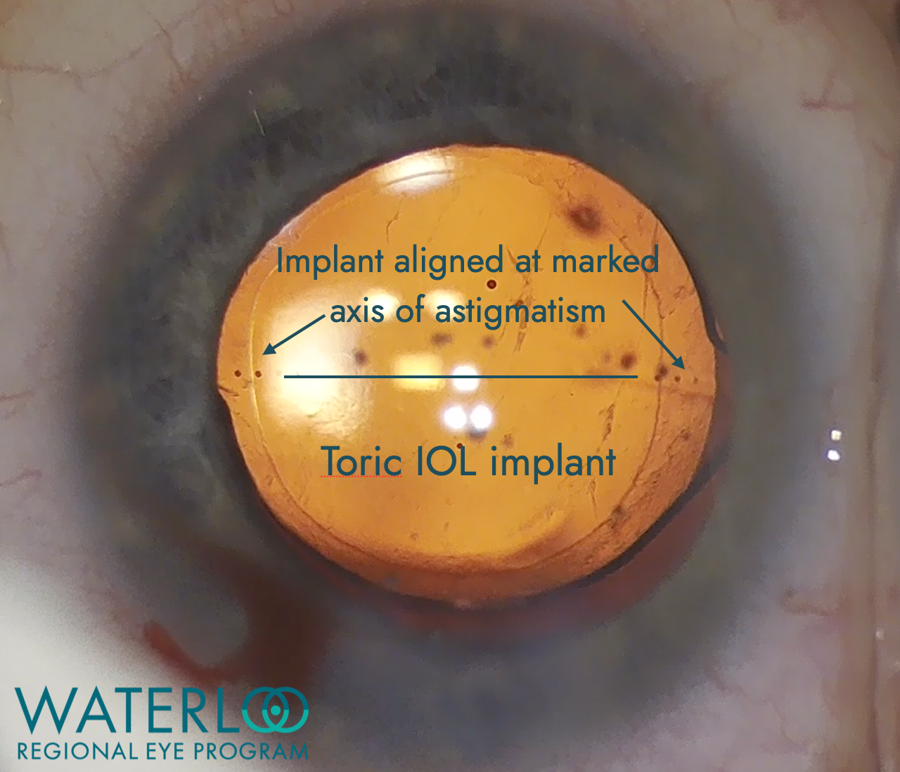 Optional non-insured testing and special feature IOL implants