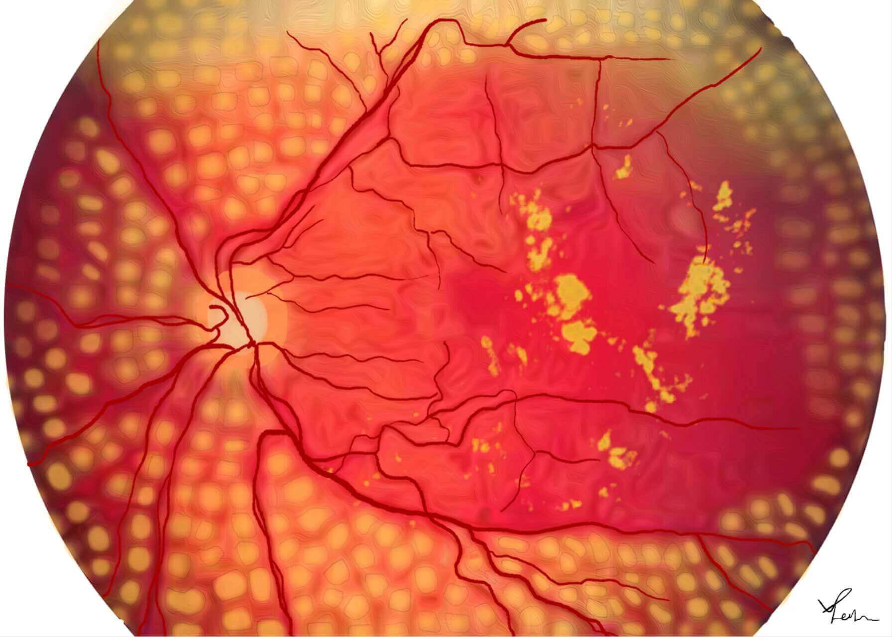 Panretinal Photocoagulation Laser PRP 