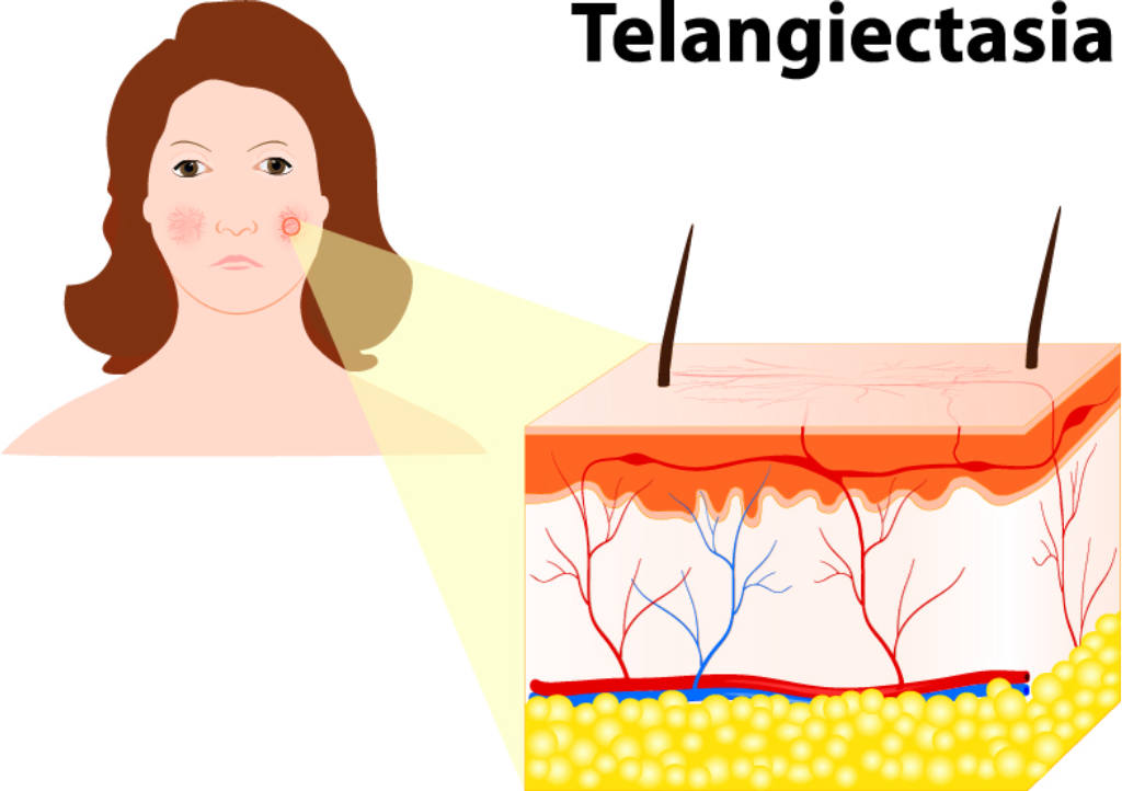 Veinwave Treatment I Tennessee Vein Center