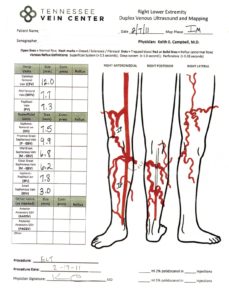 Varicose Vein Treatment in the Knoxville, TN Area I TVC