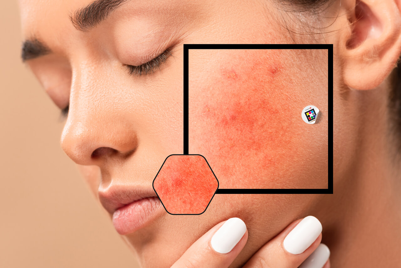 SCARLETRED - Evaluation of Treatment Efficacy through Skin Texture Analysis