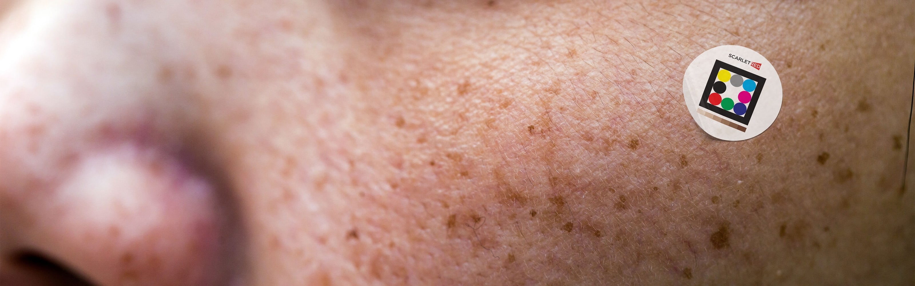 SCARLETRED - Solar lentigo - Standardized measurement of age spots