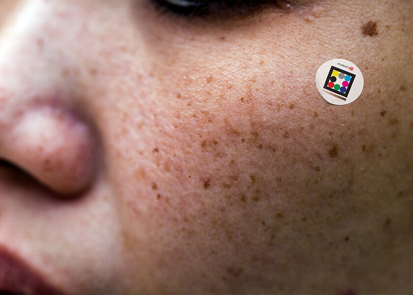 SCARLETRED - Solar lentigo - Standardized measurement of age spots