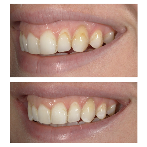 ICON White Spot Removal | Greenwich Village, NY | Dental House