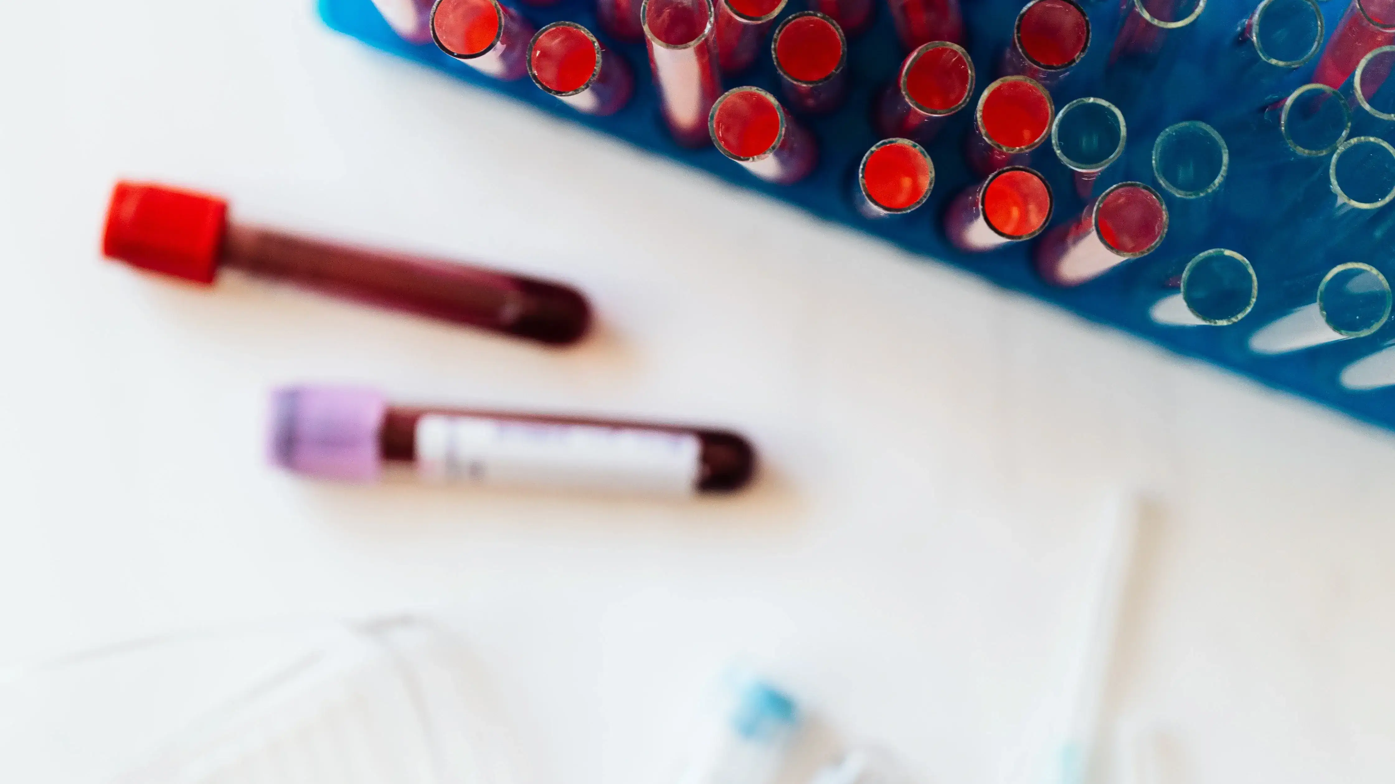 The Anti-Smith Antibody & Its Role in Diagnosing Lupus