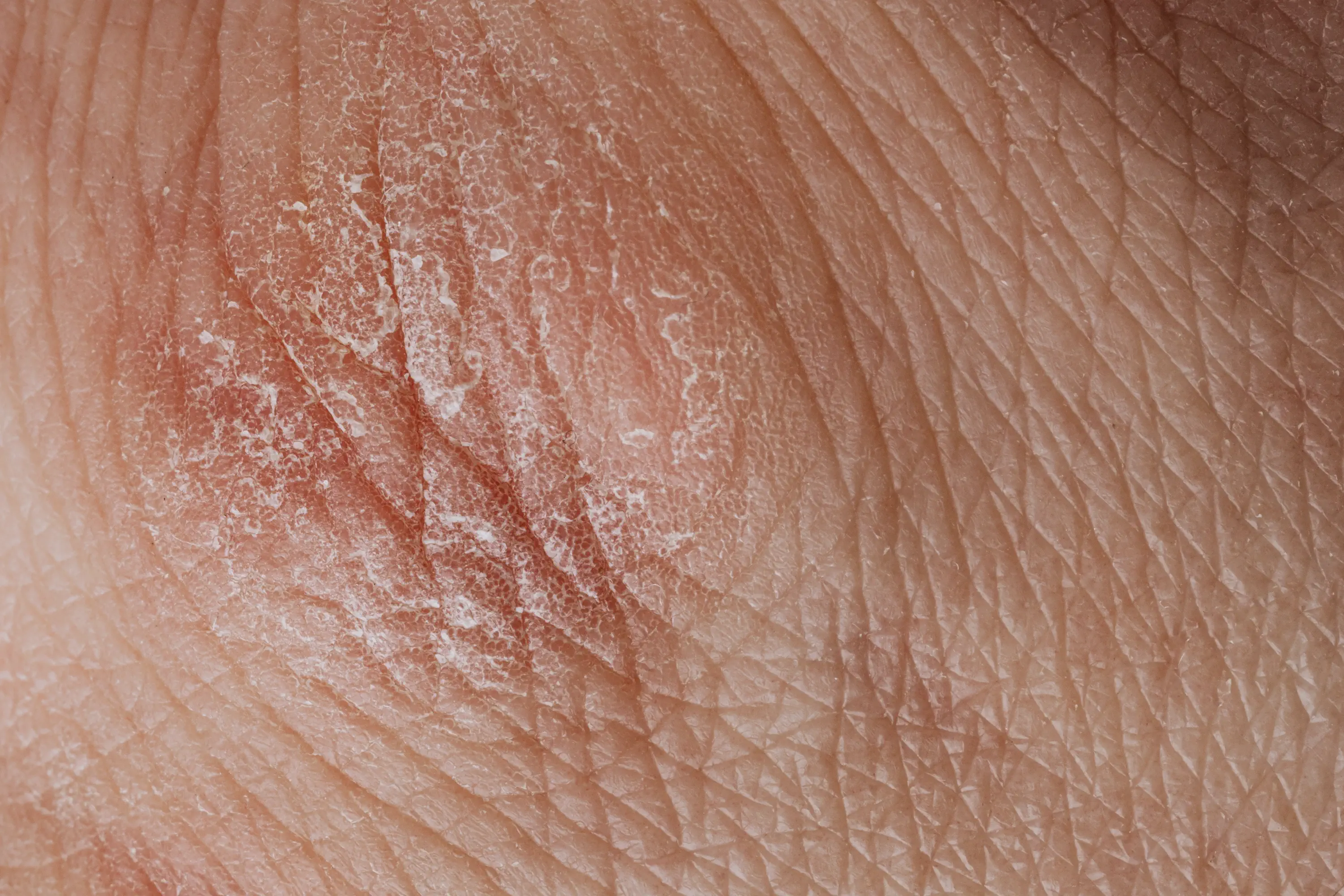 How Does Psoriasis Spread? 5 Tips for Controlling Flare-Ups