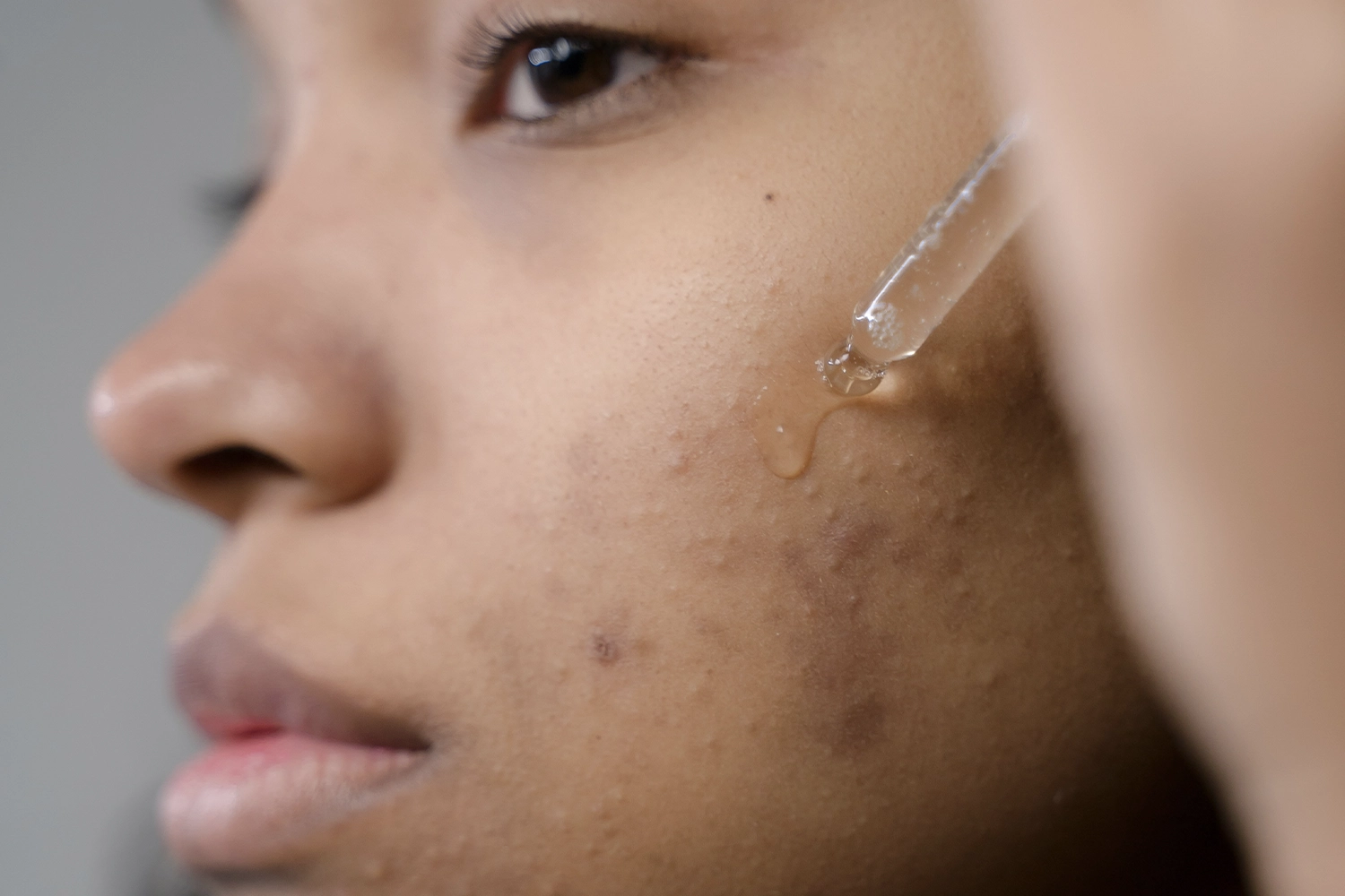 6 Hallmark Symptoms of Psoriasis on the Face