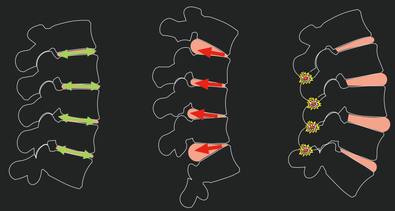 Biomechanics of the spine - posture, forces and structures | Core Advantage