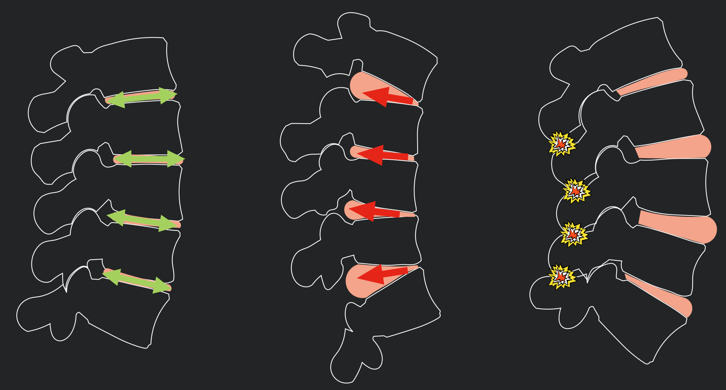 Biomechanics of the spine - posture, forces and structures | Core Advantage