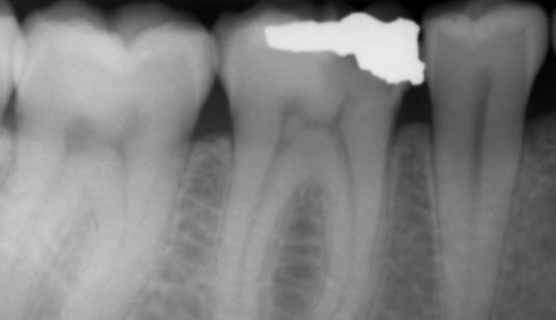 Endodontics | Treatments | The Priestgate Clinic
