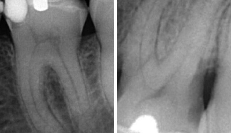 Endodontics | Treatments | The Priestgate Clinic