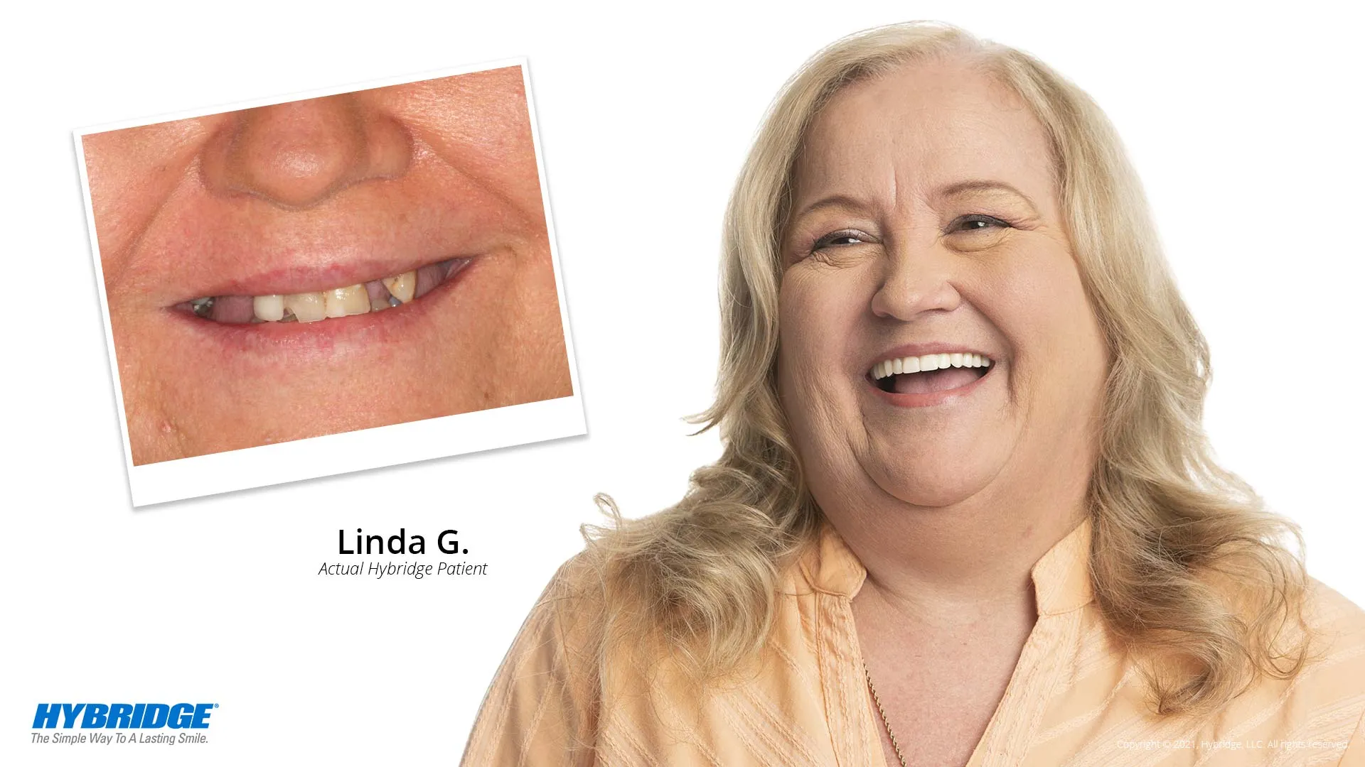 Hybridge Dental Implant Bridge | Harrisonburg, VA