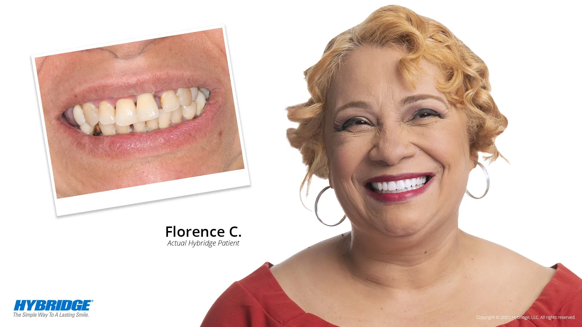 Hybridge Dental Implant Bridge | Harrisonburg, VA