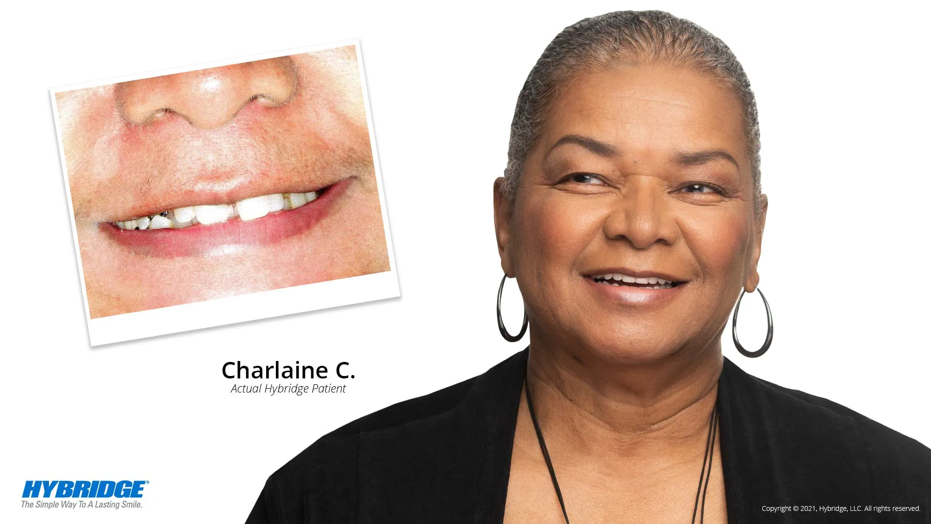 Hybridge Dental Implant Bridge | Harrisonburg, VA