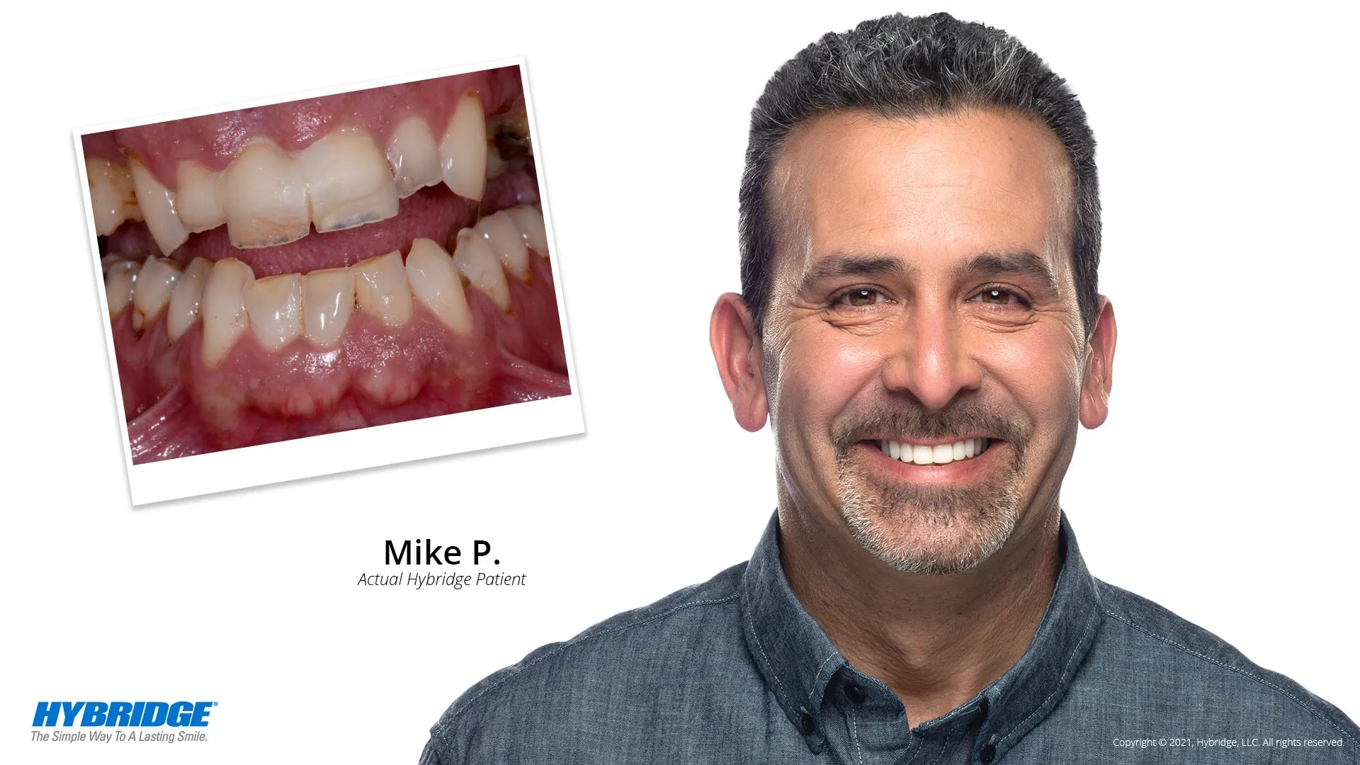 Hybridge Dental Implant Bridge | Harrisonburg, VA