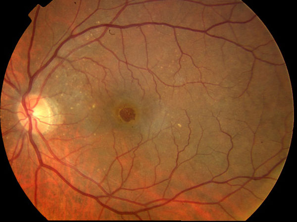 The importance of the macula | Grupo Castanera
