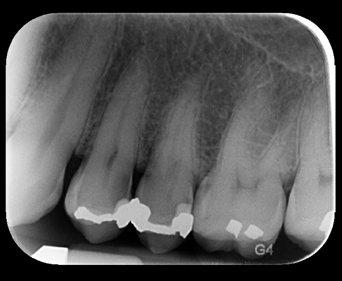 Endodontic Diagnoses to Know for the INBDE | INBDE Bootcamp