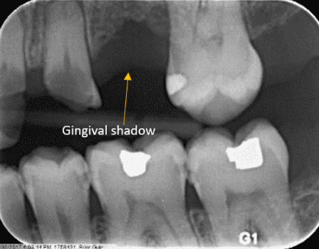 Normal Radiograph Anatomy for the INBDE | INBDE Bootcamp