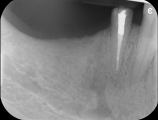Normal Radiograph Anatomy for the INBDE | INBDE Bootcamp