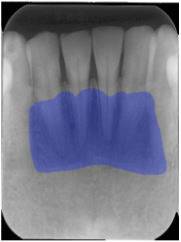 Normal Radiograph Anatomy for the INBDE | INBDE Bootcamp