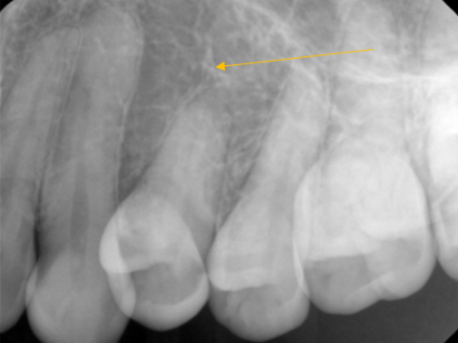 Normal Radiograph Anatomy for the INBDE | INBDE Bootcamp