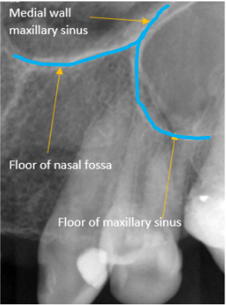 Normal Radiograph Anatomy for the INBDE | INBDE Bootcamp