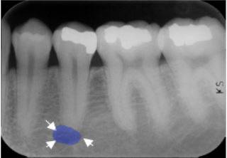 Normal Radiograph Anatomy for the INBDE | INBDE Bootcamp