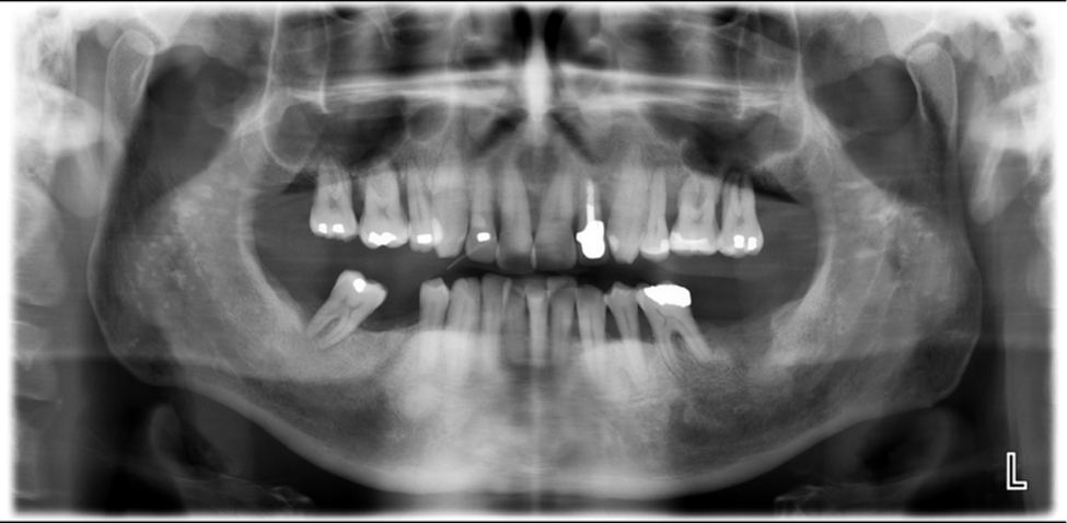 Perio Classification for the INBDE | INBDE Bootcamp