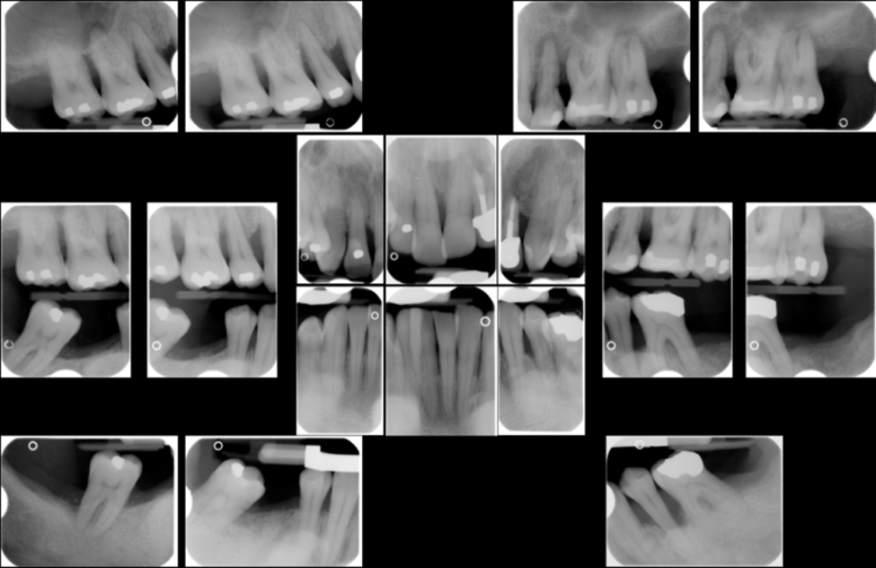 Perio Classification for the INBDE | INBDE Bootcamp