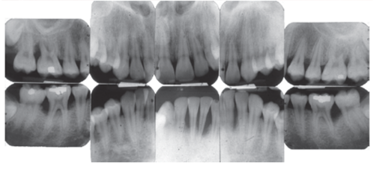 Perio Classification for the INBDE | INBDE Bootcamp