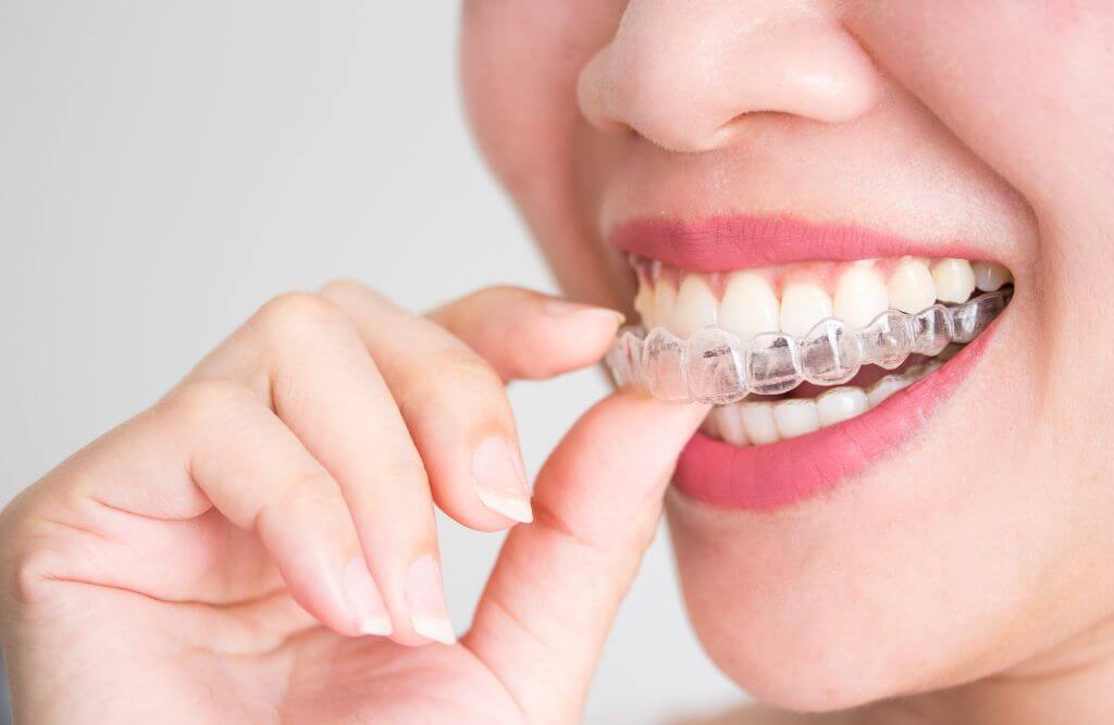 10 Important Do's and Don'ts To Follow With Invisalign - Smiles By ...
