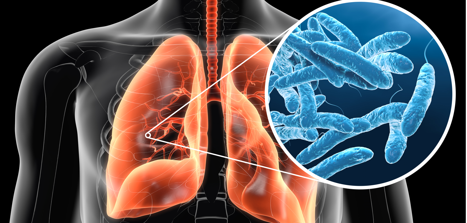 Veterans Legionnaires' Disease