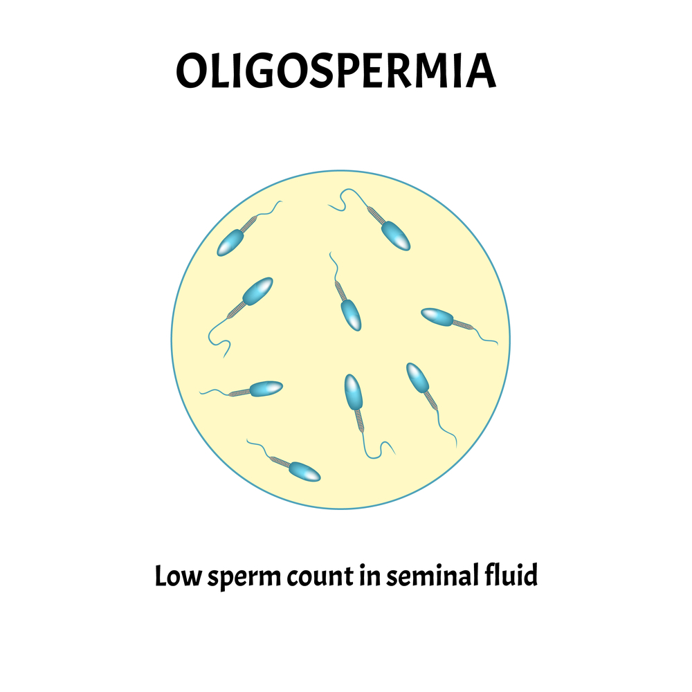 Oligospermia and Fertility: What You Should Know
